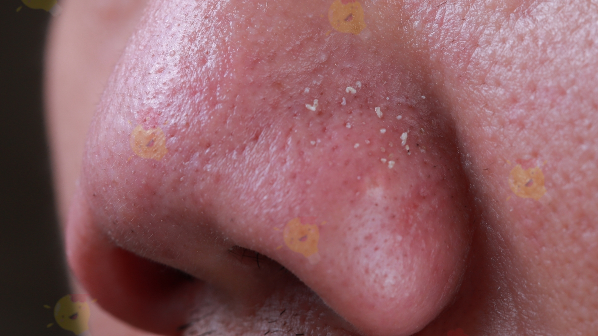 Comment Éliminer les Points Noirs sur ma Peau?